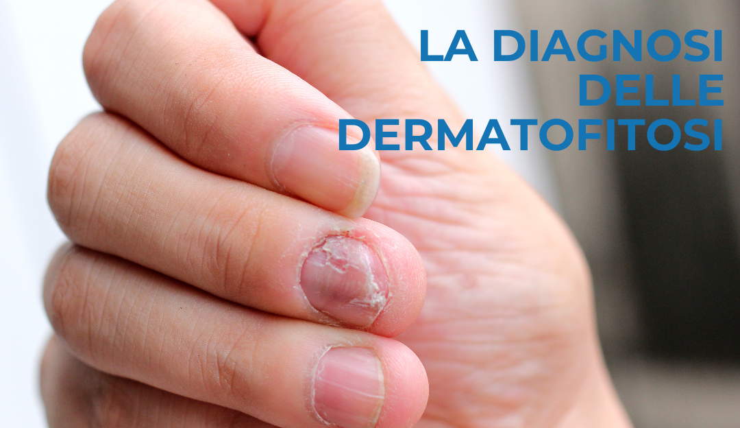 L’utilizzo delle tecniche molecolari per la diagnosi dei Dermatofiti ...